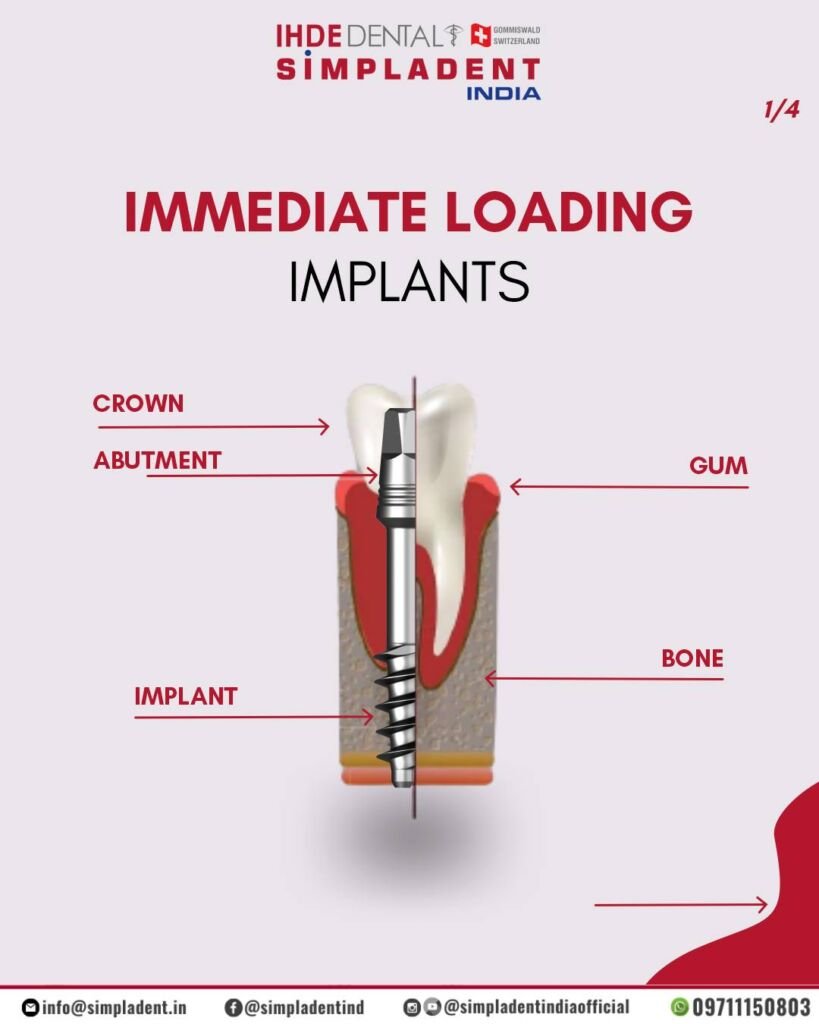 Transform Your Smile With Immediate Loading Implants - Simpladent India