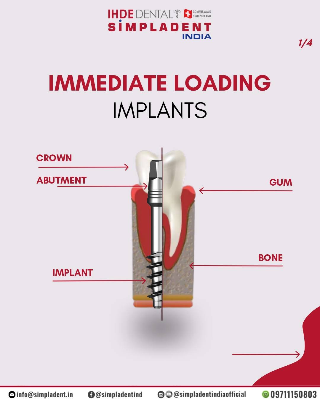 Transform Your Smile With Immediate Loading Implants - Simpladent India